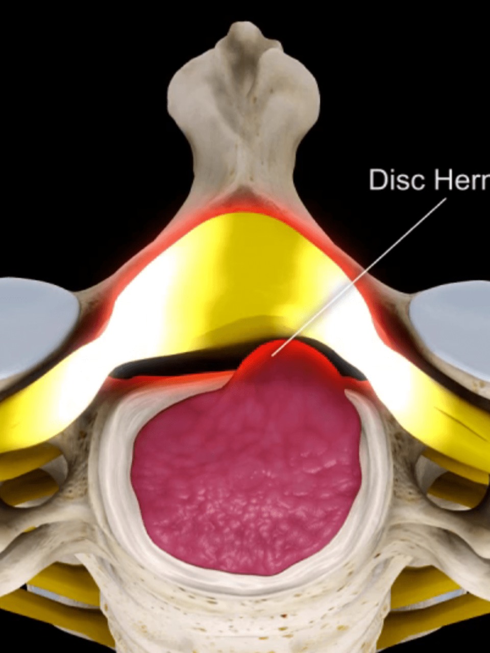 Cervical disc prolapse: what are the symptoms and treatment options ...